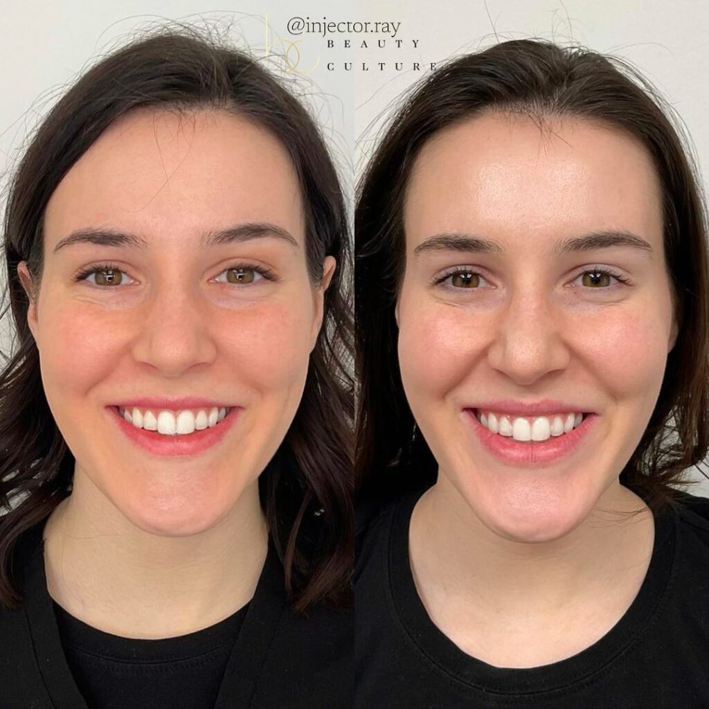 Tutto quello che c'è da sapere sul BABY BOTOX