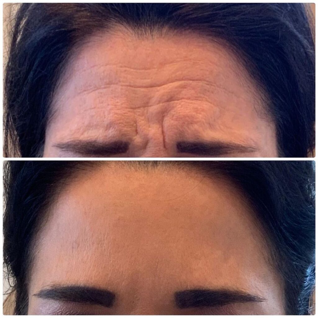 Tutto quello che c'è da sapere sul BABY BOTOX