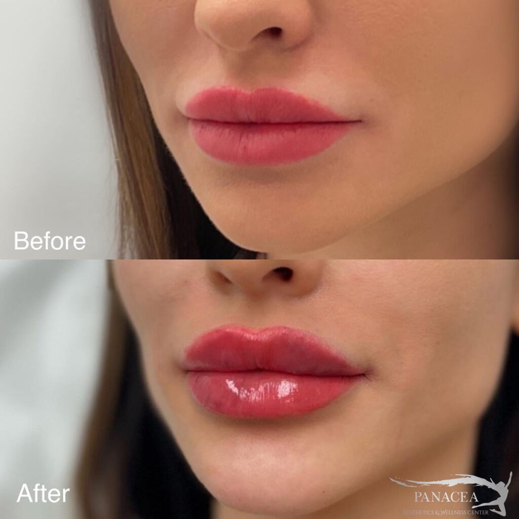 FILLER LABBRA | Tutto quello che dovresti sapere