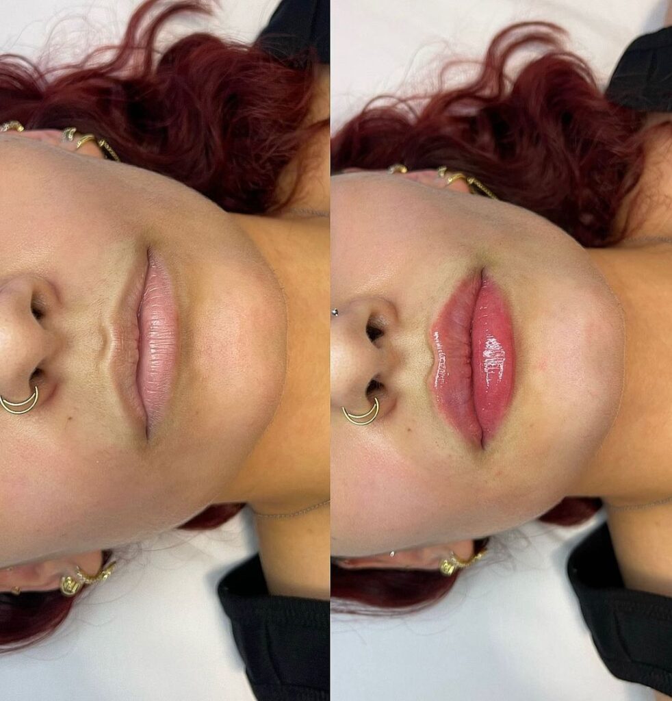 FILLER LABBRA | Tutto quello che dovresti sapere