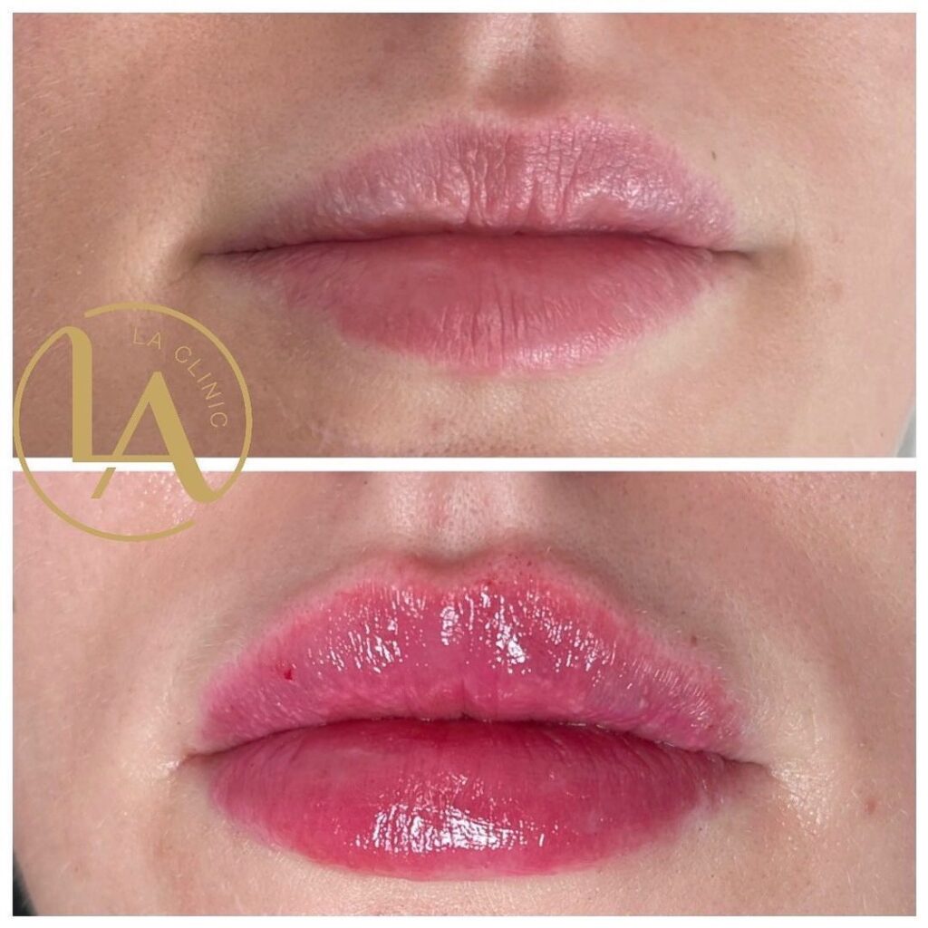 FILLER LABBRA | Tutto quello che dovresti sapere