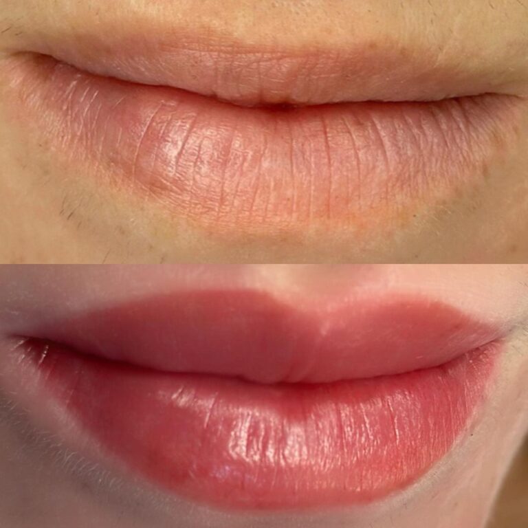 FILLER LABBRA | Tutto quello che dovresti sapere