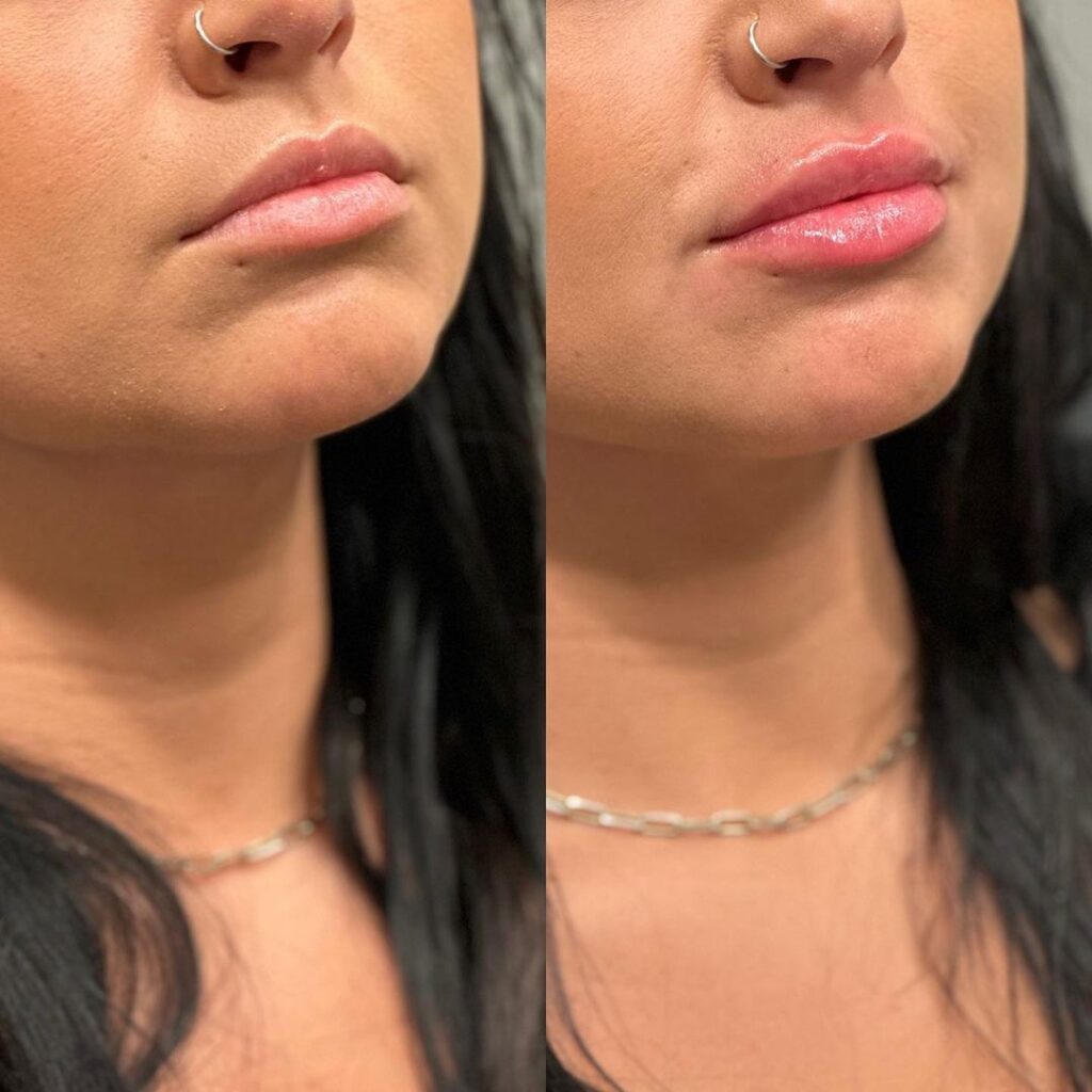 FILLER LABBRA | Tutto quello che dovresti sapere