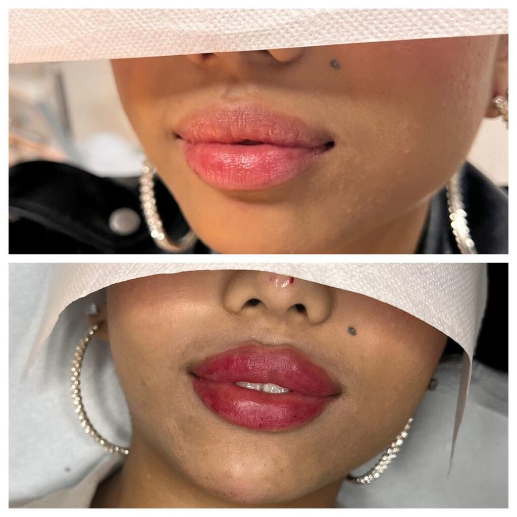 FILLER LABBRA | Tutto quello che dovresti sapere