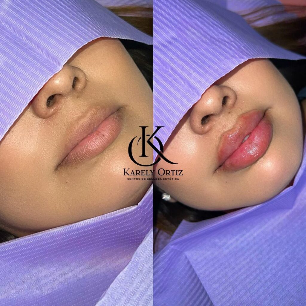 FILLER LABBRA | Tutto quello che dovresti sapere