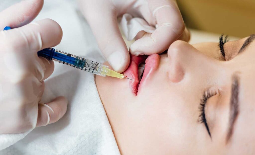FILLER LABBRA | Tutto quello che dovresti sapere