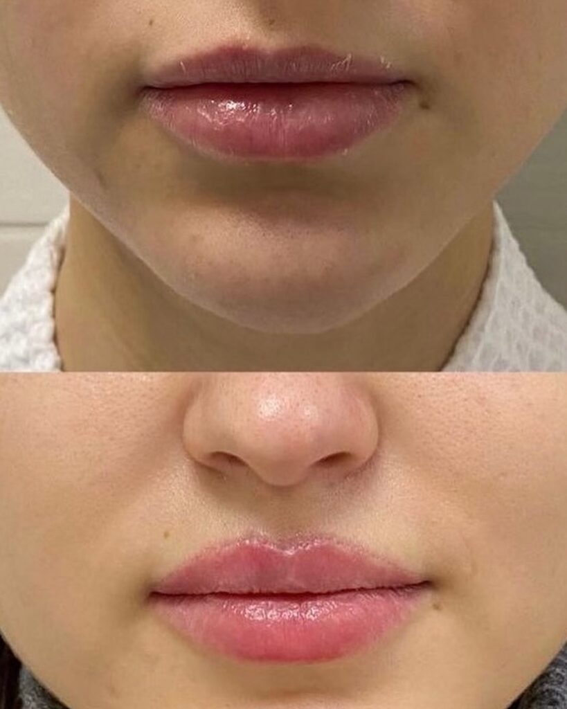 LIP LIFT | L'alternativa definitiva al filler labbra