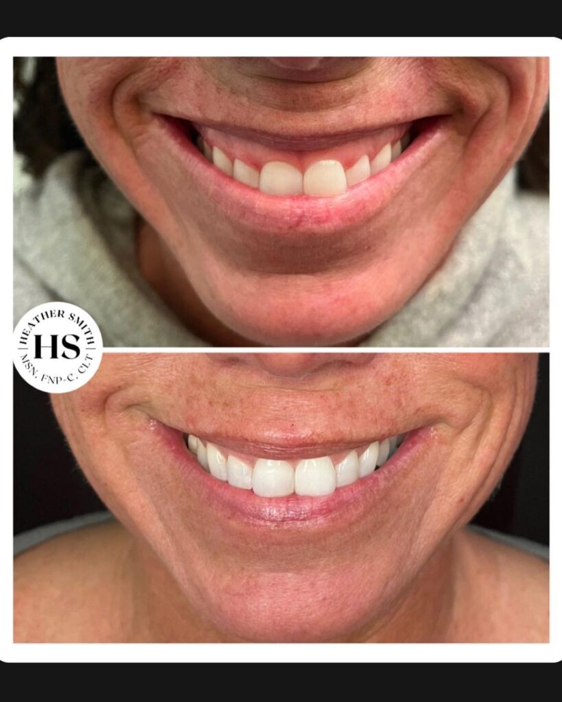 BOTOX LABBRA | Guida completa per un trattamento perfetto