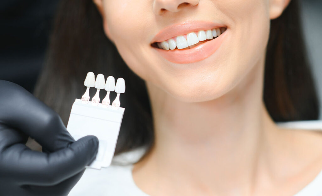 Denti perfetti? Merito delle FACCETTE DENTALI