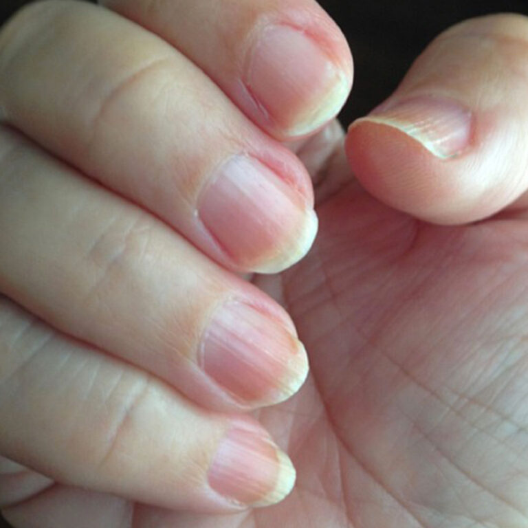 UNGHIE RIGATE | Cause, rimedi e consigli utili